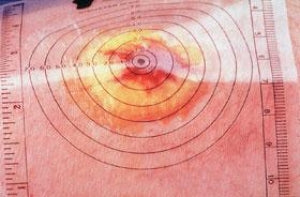 Bullseye Grid Wound Measuring Guides | Gilgal Medical Supplies Inc